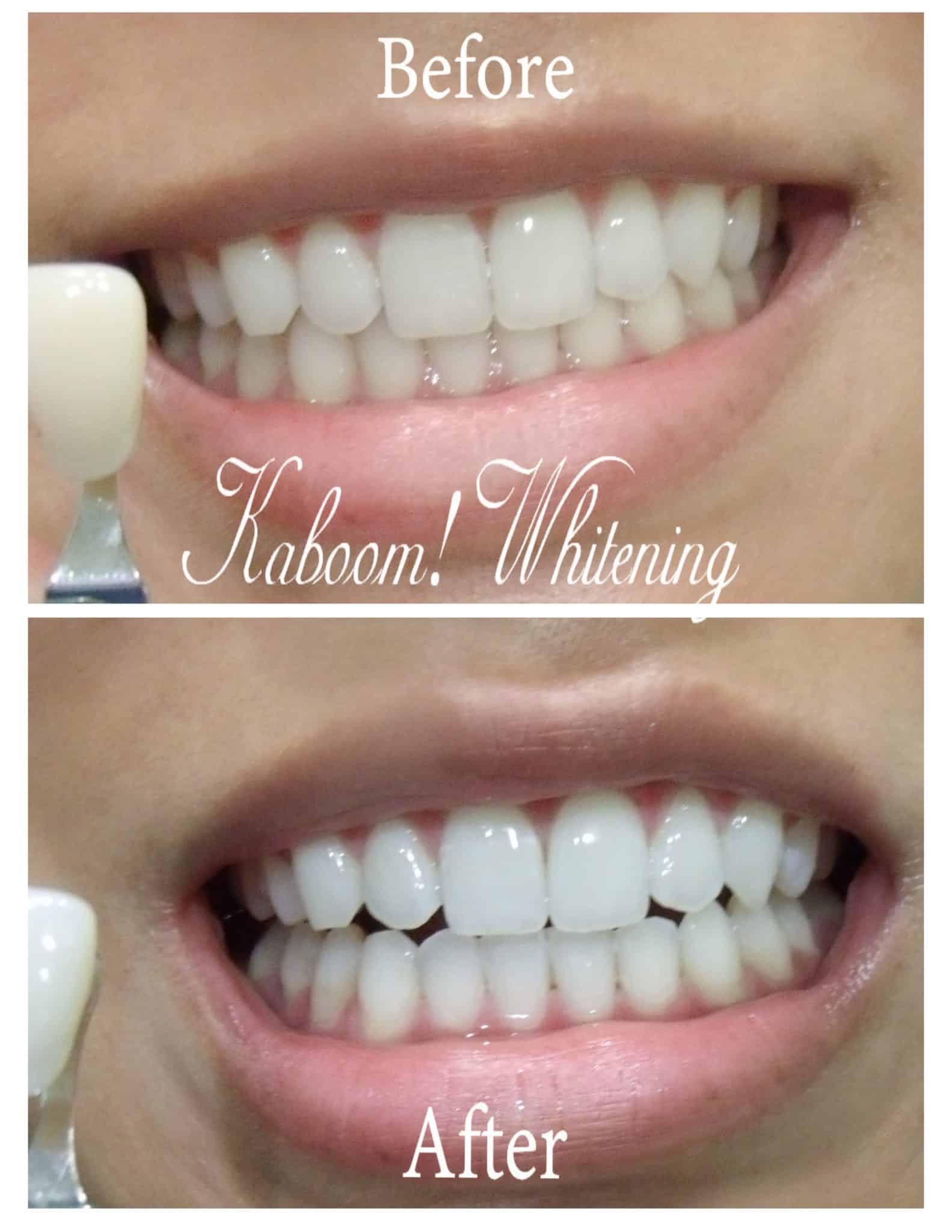 Teeth Whitening Promotion