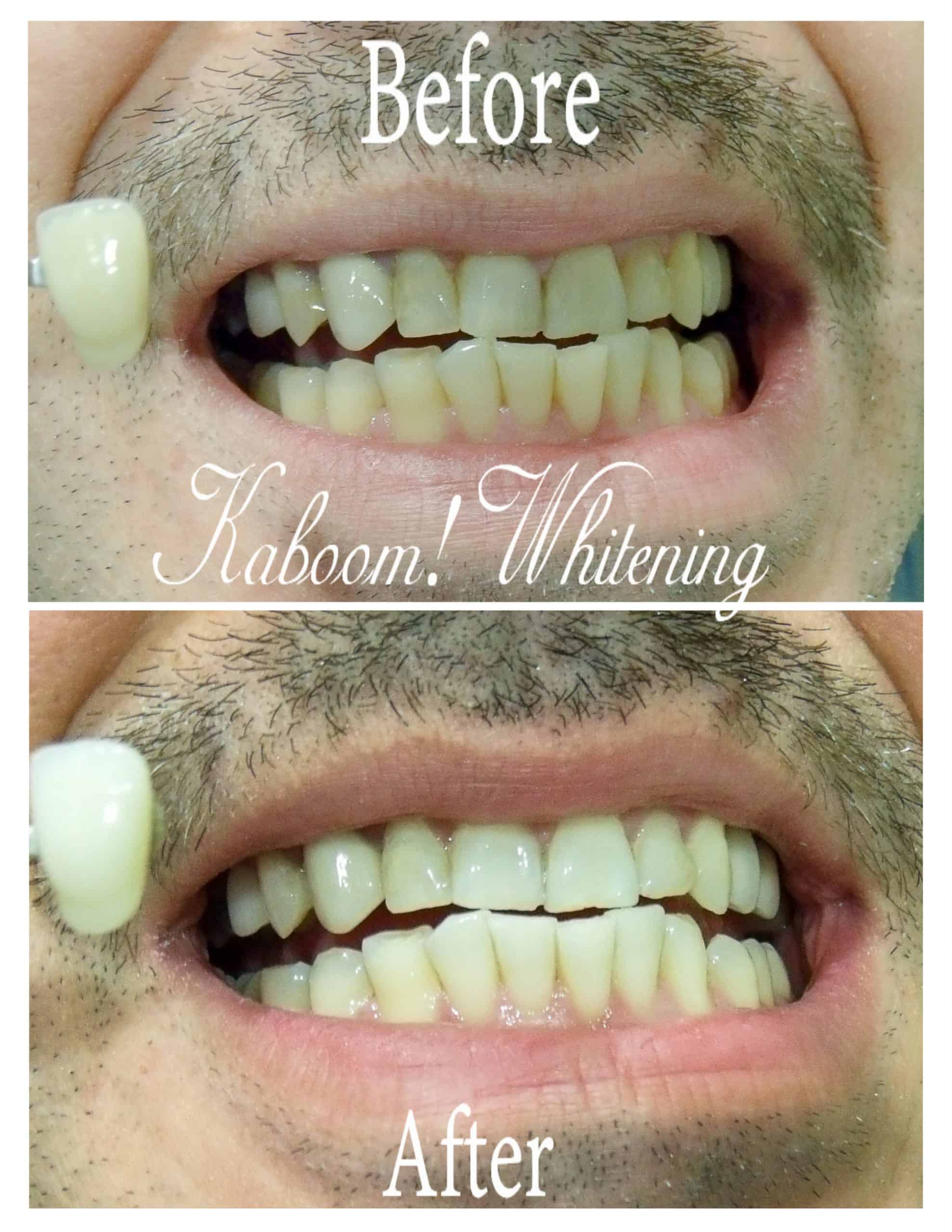 Teeth Whitening | Photo Gallery | Before - After | Manhattan