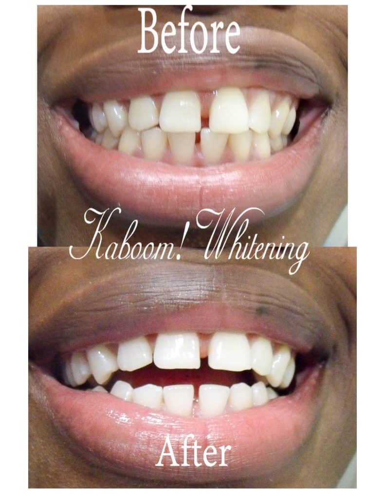 Teeth Whitening | Photo Gallery | Before - After | Manhattan