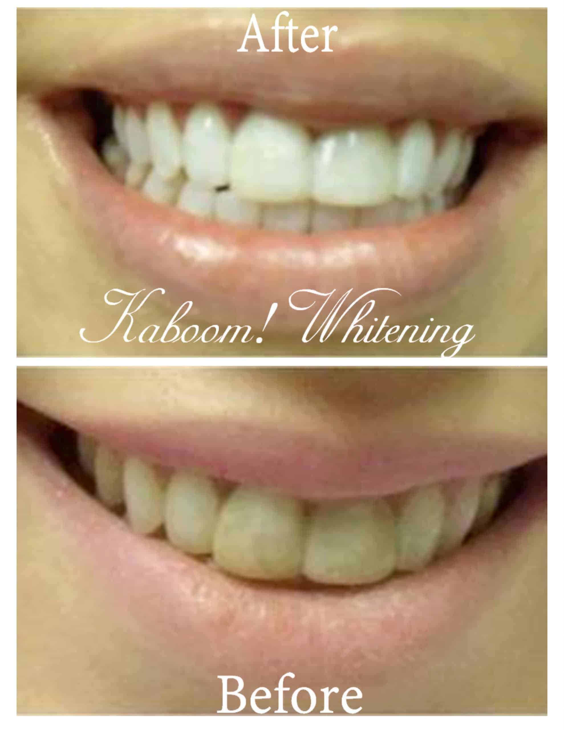 Teeth Whitening | Photo Gallery | Before - After | Manhattan